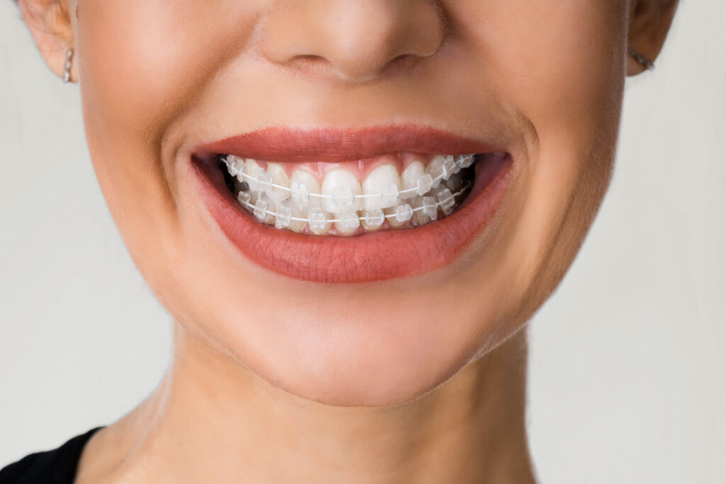Different Types of Dental Braces & How to Choose in Renton