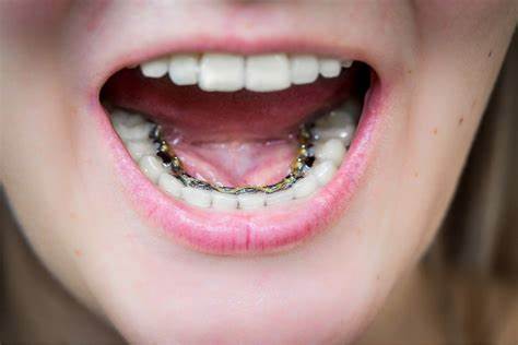 Different Types of Dental Braces & How to Choose in Renton